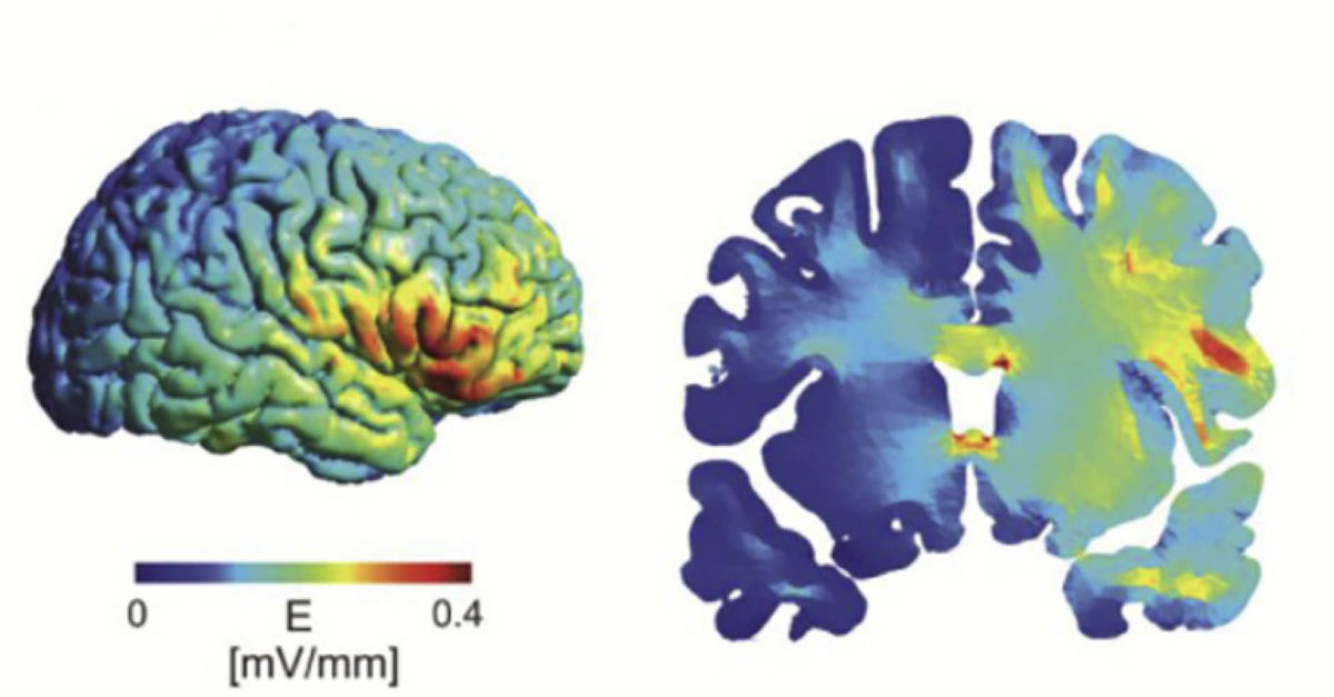 Cognitive-boosting electrical stimulation is influenced by brain ...
